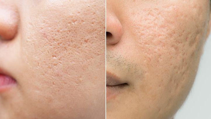 What are the 7 top causes of acne? Which foods cause it ? - All about ...