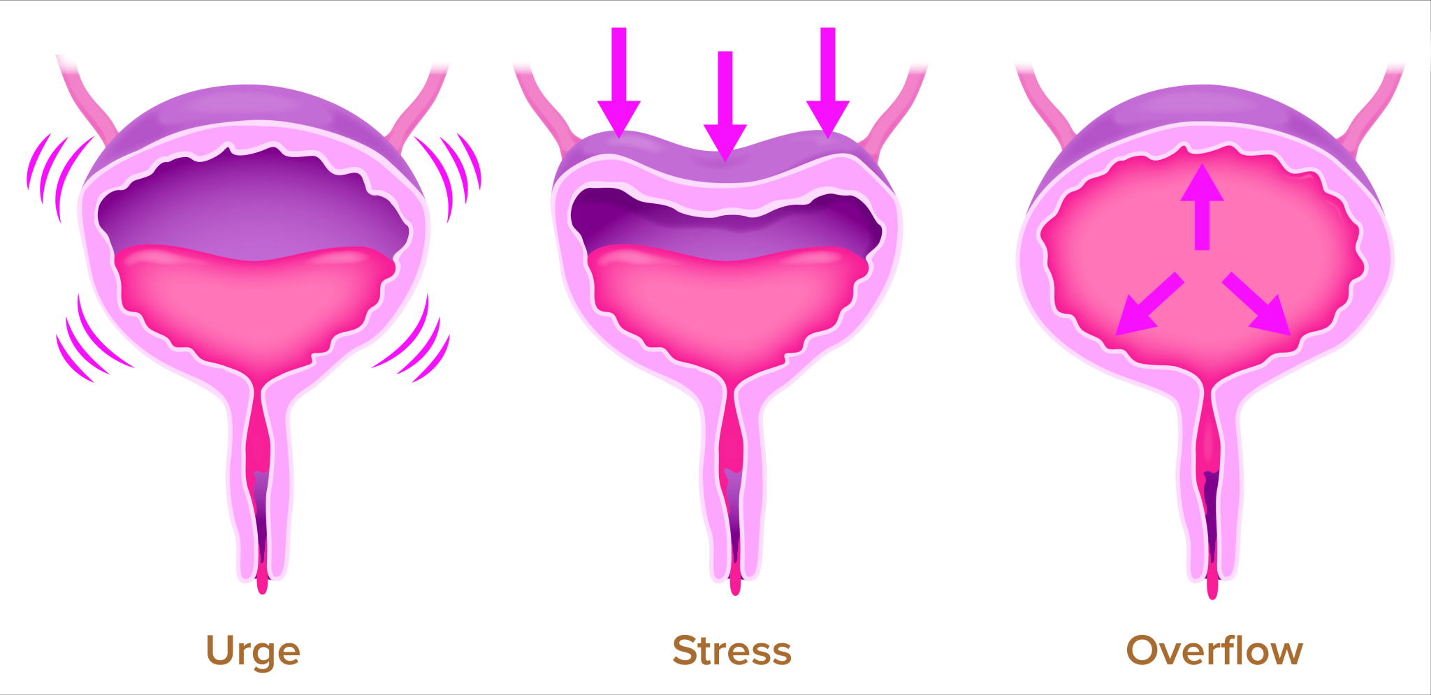 Urinary incontinence - Types, Symptoms and causes - All about your ...
